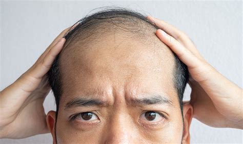 Hair Loss Expert Reveals How Wearing A Hat Could Lead To Shedding