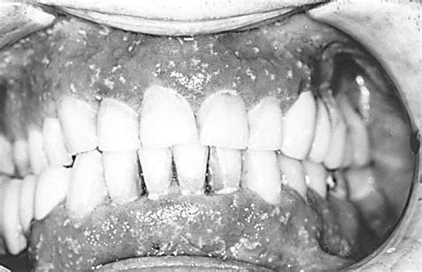 Pyodermatitis Pyostomatitis Vegetansreport Of A Case And Review Of The Literature Oral Surgery