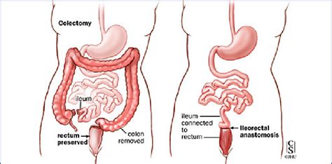 A Resection Of The Cecum And Ileum B Ileorectal Anastomosis Download Scientific Diagram