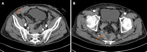 Contrast Enhanced Computed Tomography Imaging Scans 1 Mo After Surgery Download Scientific
