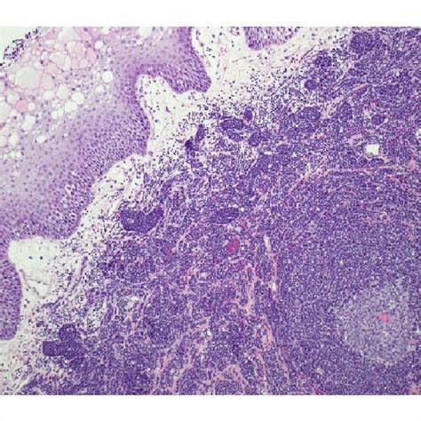 Photomicrograph Of The Underlying Tonsil Shows Markedly Reactive