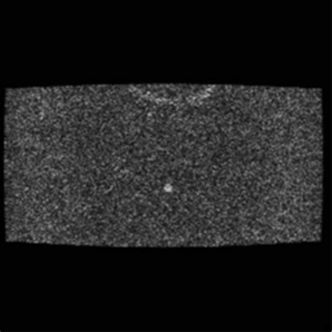 Choroid Plexus Papilloma Radiopaedia 34951 36441 Axial Dwi Nc Commons