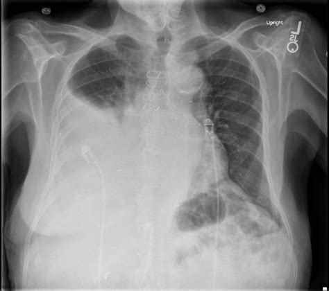 Reexpansion Pulmonary Edema Cxr 1 Ap Jetem 2017 Jetem