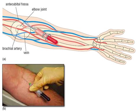 Diabetes Complications Figure 7 A Diagram Of Veins In A Forearm