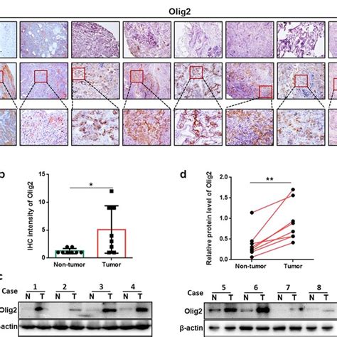 Olig2 Was Overexpressed In Lung Cancer Tissues A The Representative Download Scientific Diagram