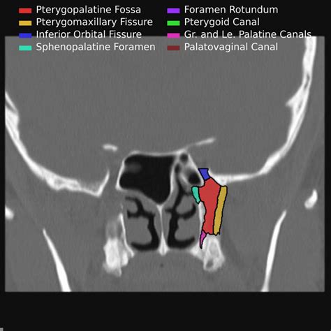 Pterygopalatine Fossa Diagram