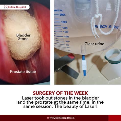 Prostate Draining