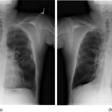 Subjective Assessment Of The Proposed Multimodal Compression Method And