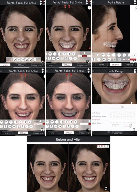 Esthetic Treatment Planning With Digital Animation Of The Smile