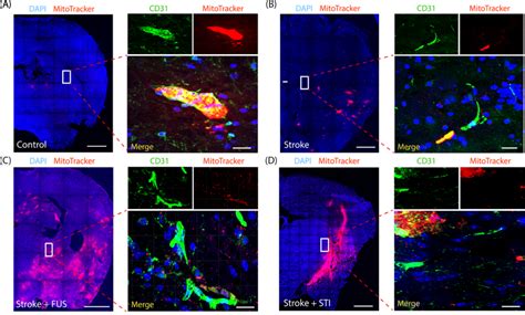 Focused Ultrasoundfacilitated Mitochondria Delivery Helps Treat Stroke