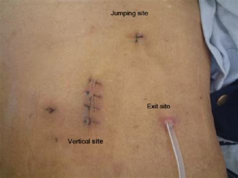 Dialysis Catheter Infection Treatment At Katie Jenkins Blog