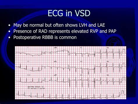 Ppt Ventricular Septal Defects In Congenital Heart Disease Powerpoint