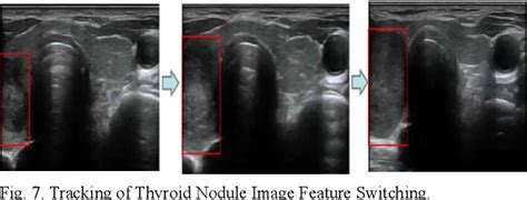 Figure 7 From Research On Single Object Tracking Algorithm For Thyroid
