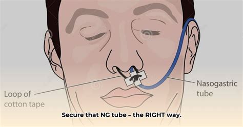 How To Use A Nasal Bridle For Ng Tube Securement The Green Grid