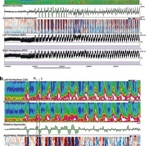 Using Quantitative Eeg Tools To Aid Review And Interpretation In A Download Scientific Diagram