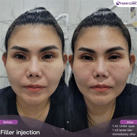 Dermal Fillers Before And After Photos Siam Clinic Thailand