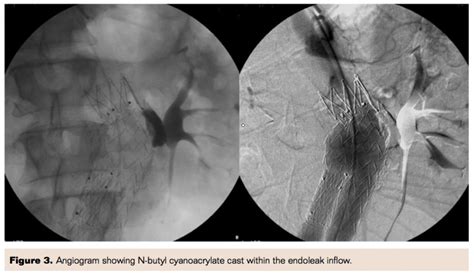 Type I Endoleak Management After Endovascular Repair Vdm