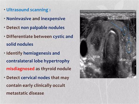Approach To Thyroid Nodule PPTX Thyroid Disorders Endocrine And Metabolic Diseases