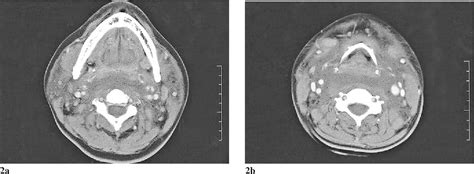 Figure 1 From Diffuse Neck Swelling After Car Accident Semantic Scholar