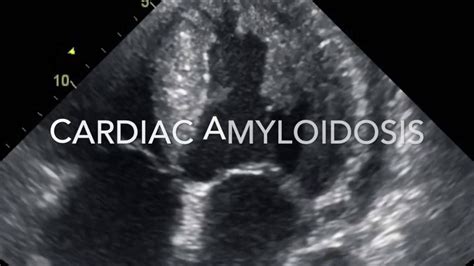Cardiac Amyloidosis Case No2 Youtube
