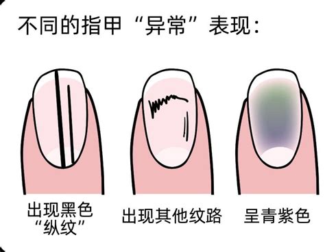 醇鲜然羊大师丨指甲会显示身体病变 千万要小心 知乎