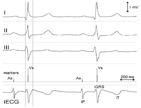 From Top To Bottom Surface Ecg Leads I Ii Iii Pacemaker Event