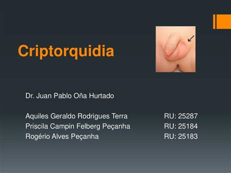 Criptorquidia Fernanda Gurgel Udocz