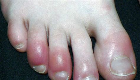 Got Redness Around Toenail Nail Surgery Could Help