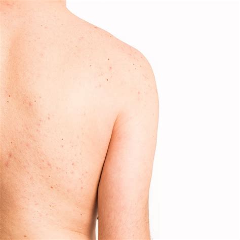 3 Top Treatments For Back Acne What Is Back Acne And How Do We Stop I