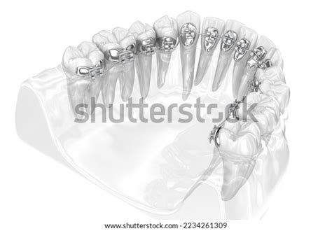 Lingual Orthodontics Over 249 Royalty Free Licensable Stock