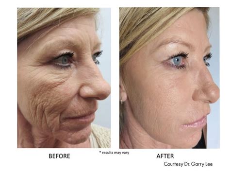 Prp Facial Before And After Dallas 3 Amy A Vaughan Md Dermatology