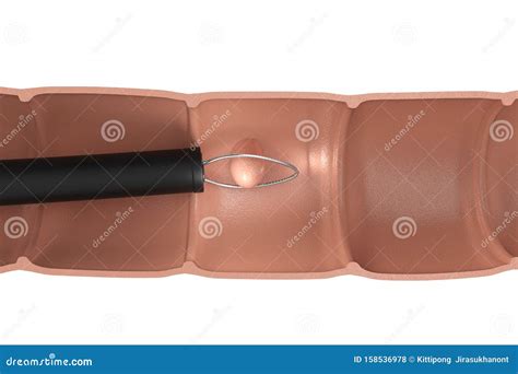 Endoscope Remove Colonic Polyp Stock Illustration Illustration Of