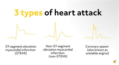 St Segment Elevation Myocardial Infarction Stemi