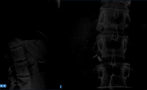 Are Surgical Clips Safe For Mri At Bruce Huggins Blog