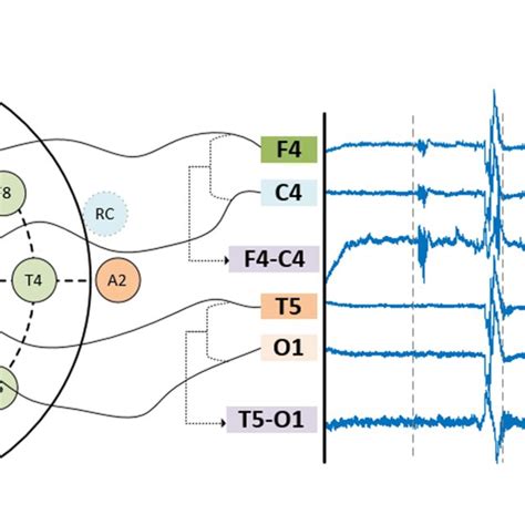Steps Involved In The Automated Detection Of Abnormal Eeg Signals