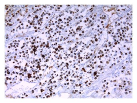Microscopic Findings Of The Right Axillary Mass Showed Diffuse Sheets