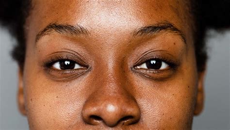 How To Remove Dark Spots On Face Fast See Results Overnight