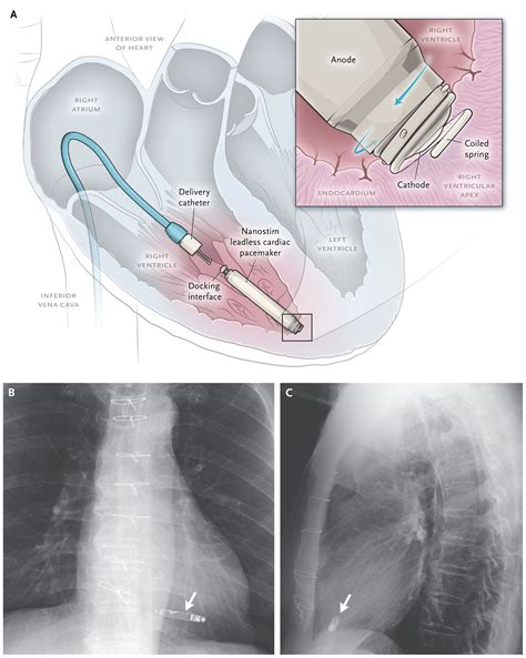 Percutaneous Implantation Of An Entirely Intracardiac Leadless