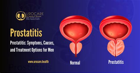 Prostatitis Symptoms Causes And Treatment Options For Men Dr Sanjay K Binwal