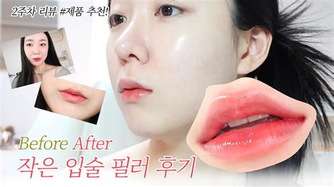 작은 입술필러 후기 비용 통증 부작용 비포 애프터까지 Youtube