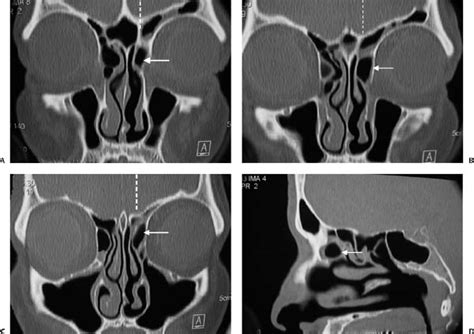 Frontal Ethmoidal Recess Treatment Of Failed Frontal Sinus