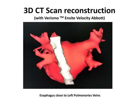 Atrial Fibrillation Cryoablation Esophagus Pptx Surgery Medical Health