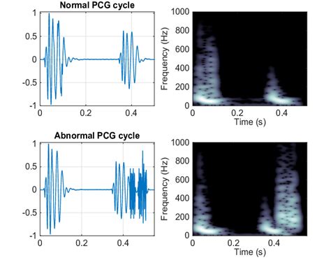 Top Time Waveform And Spectrogram Of A Normal Pcg Signal Bottom Time