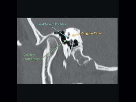 Normal Temporal Bone Ct With Annotated Images Radiopaedia 84293 99584 Poschl Annotated Nc