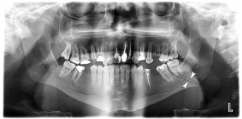 Mandibular Fracture X Ray