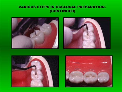 Class Ii Amalgam Preparation Ppt