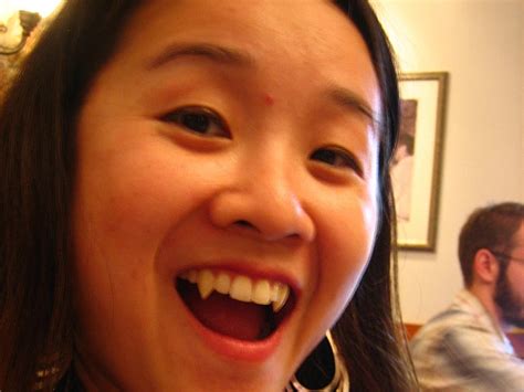 Yaeba Teeth Before And After Crooked Teeth Causes And Treatments