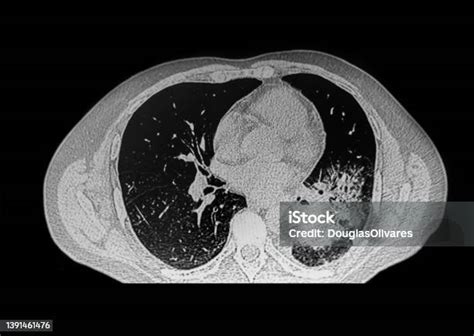 폐 종양을 가진 남성 환자의 Cat 스캔 Mri 스캔에 대한 스톡 사진 및 기타 이미지 Mri 스캔 폐암 전이성 종양 Istock