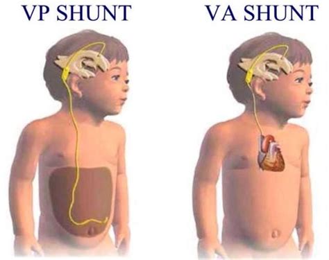 Vp Shunt Ultrasound Vp Shunt Device Mgnar