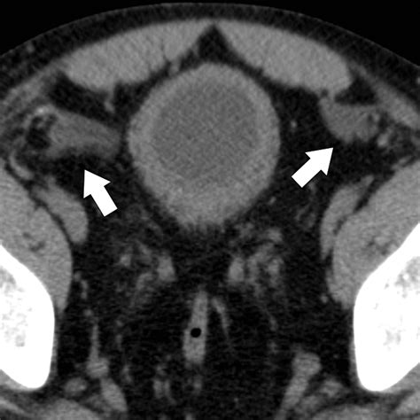 Multitechnique Imaging Findings Of Prolene Plug Hernia Repair Ajr